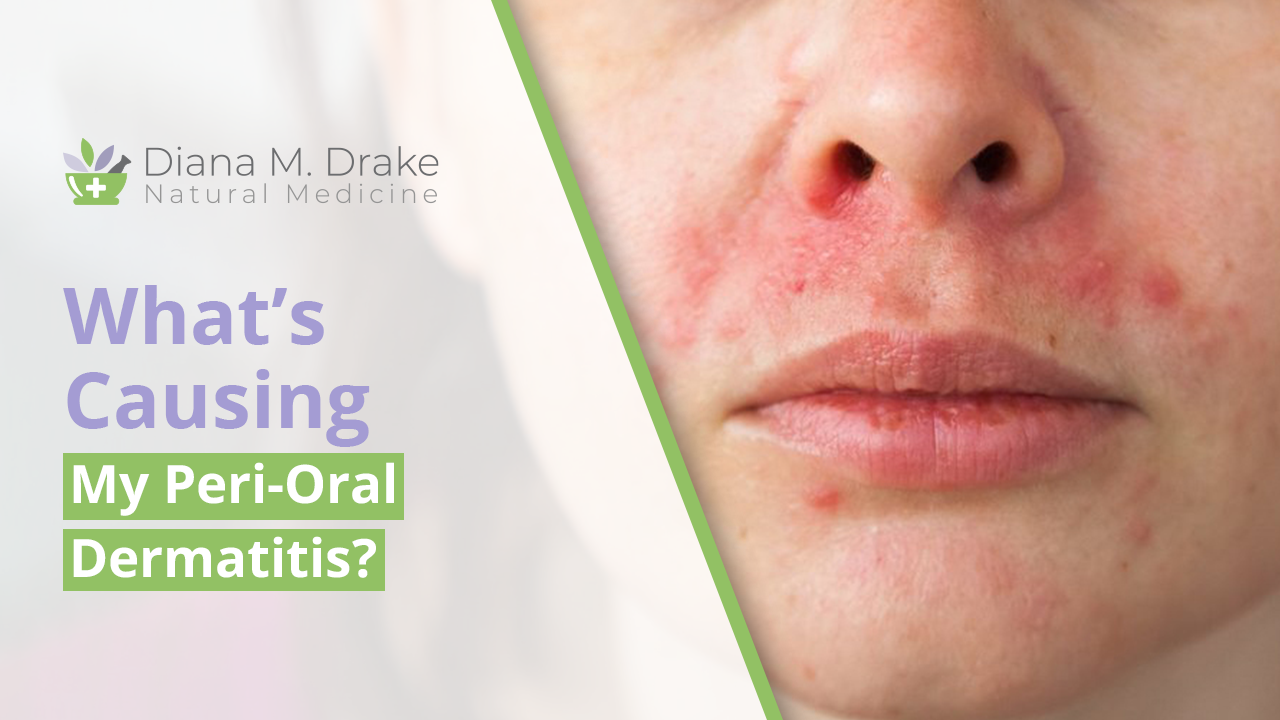 What's Causing My Peri-Oral Dermatitis?